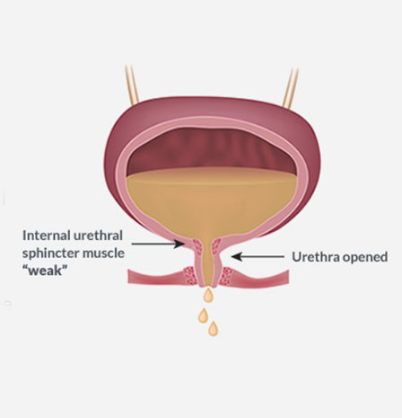 Urethral Bulking – UCOSC